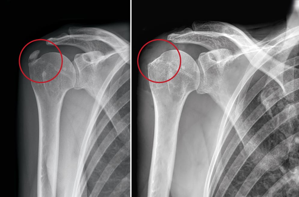 Lavage / Wash-out van kalk op een pees - RX Mariakerke